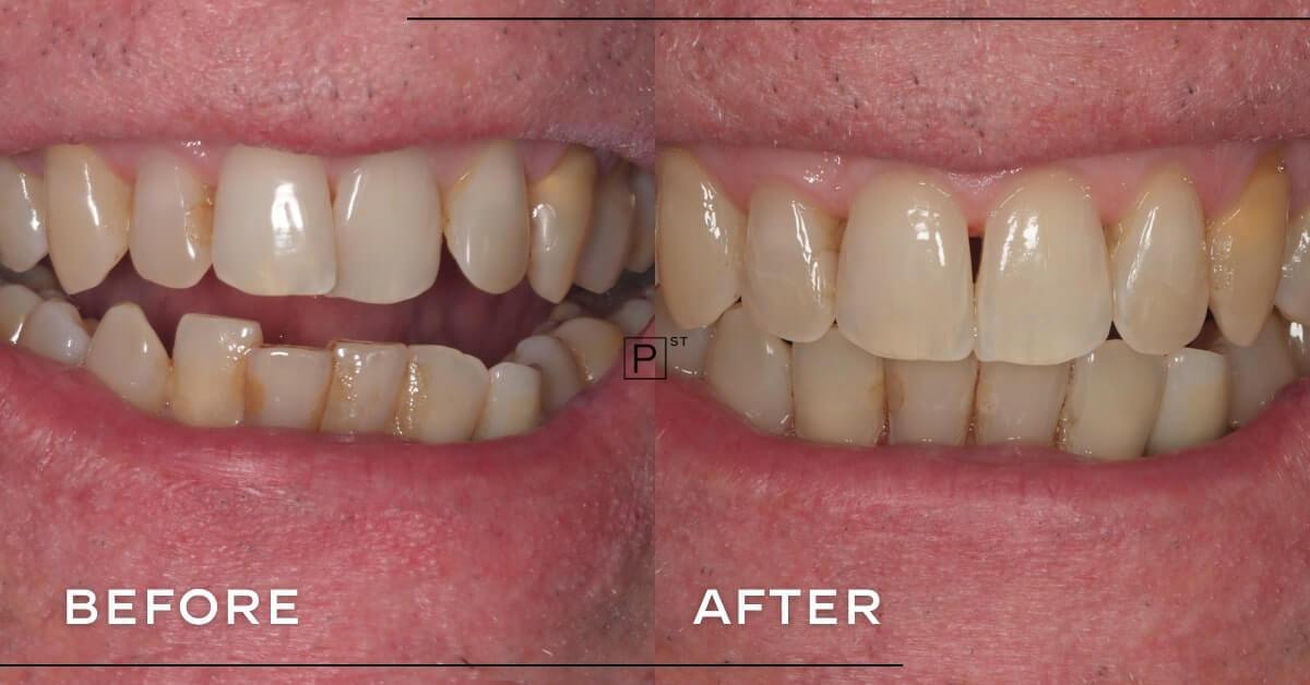 Ted of Bronte’s Invisalign Makeover | Pitt Street Dental Centre
