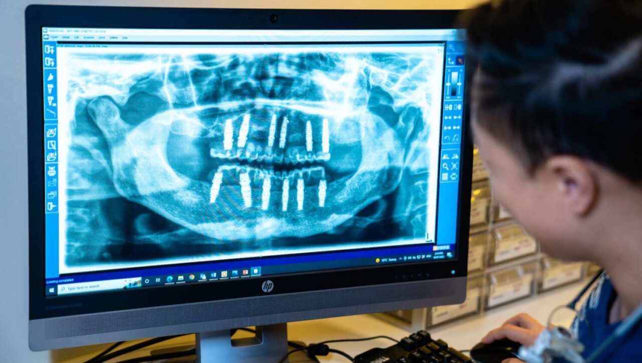 What Is Full Arch on Implant? | Pitt Street Dental Centre