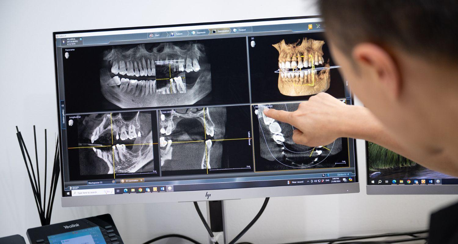 Front Teeth Implants Aesthetic Zone in Sydney | Pitt Street Dental Centre