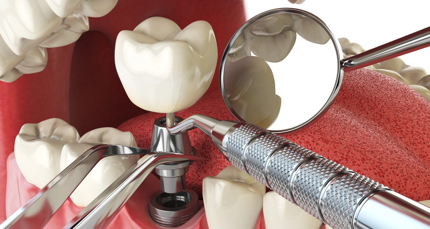 The Vanishing Act Your Jawbone Pulls After Tooth Loss (And How To Stop ...